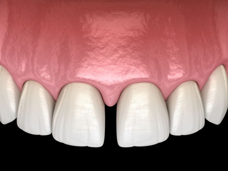 ¿Qué es un diastema? | Clinica Dental Gingiva